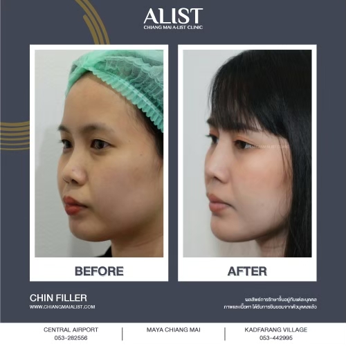 เสริมคาง - ALIST Clinic